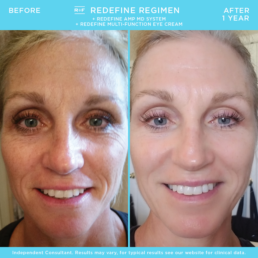 20 Rodan and Fields Before and After Pictures That Will Shock You - The ...