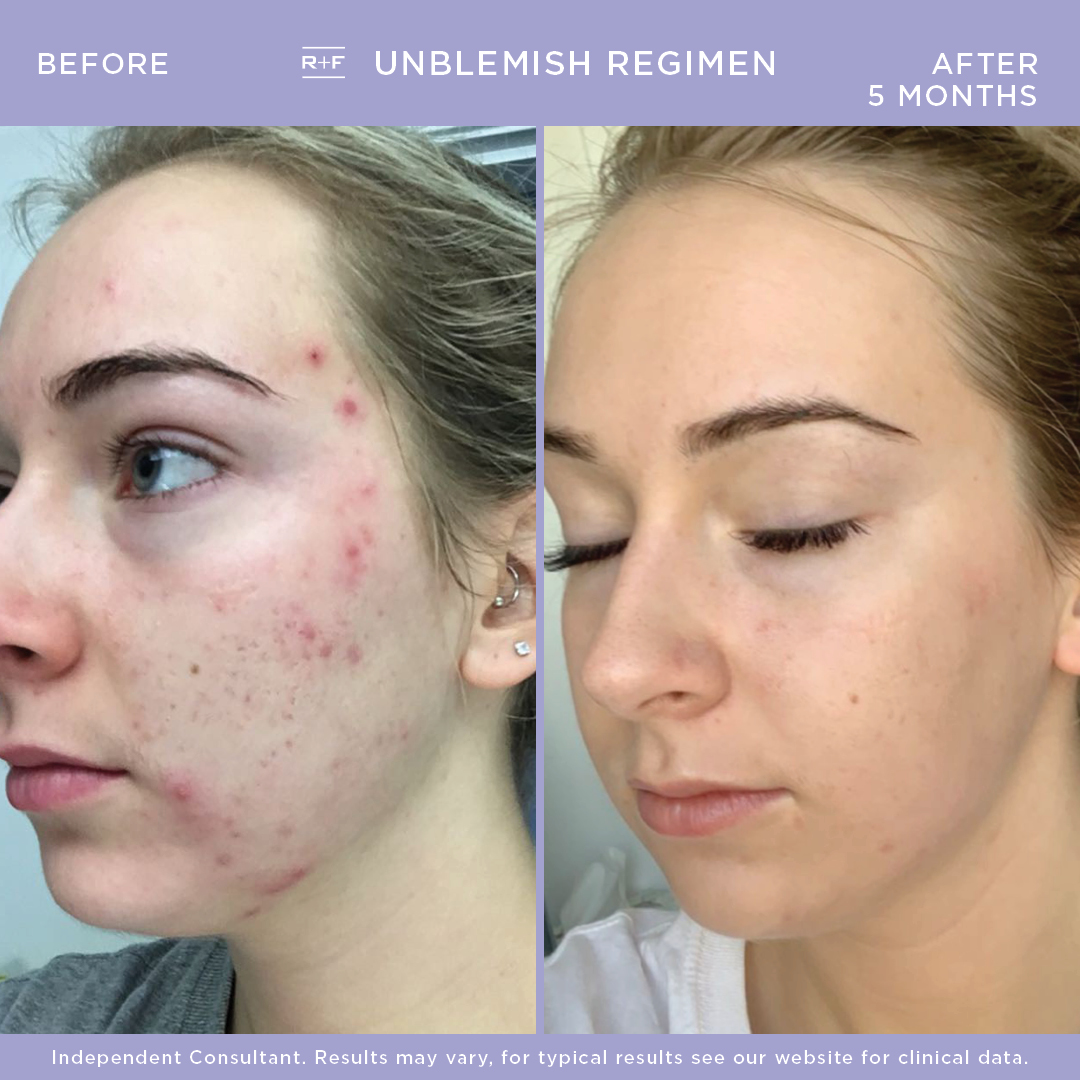 20 Rodan and Fields Before and After Pictures That Will Shock You - The ...